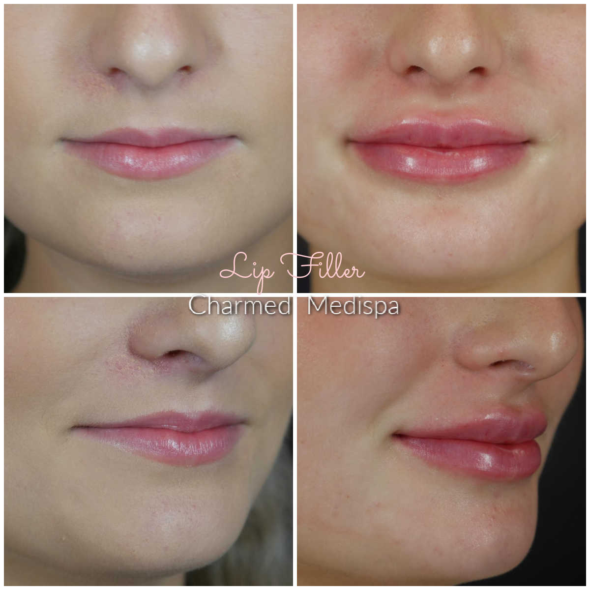 Russian Lip Filler On Thin Lips Lipstutorial